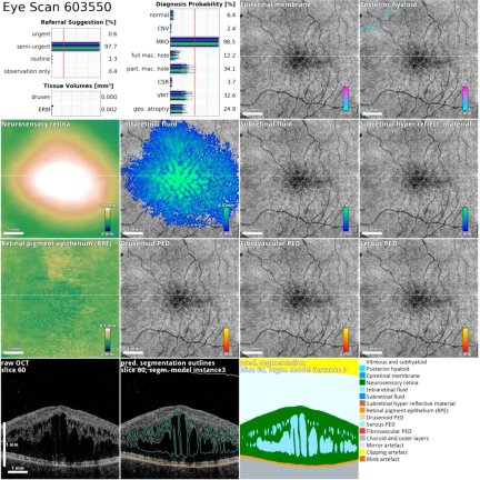 Artificial intelligence in retinal optical coherence tomography (OCT ...
